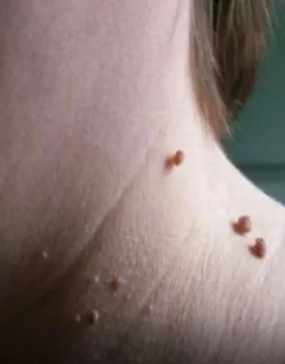 Skin Tags - Medical Spa & Laser Clinic in Richmond Hill | Spadana Medi Spa